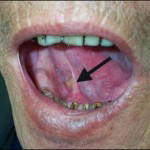 Cancer Pictures - Cancer of the Mouth, Lip & Tongue - KillTheCan.org